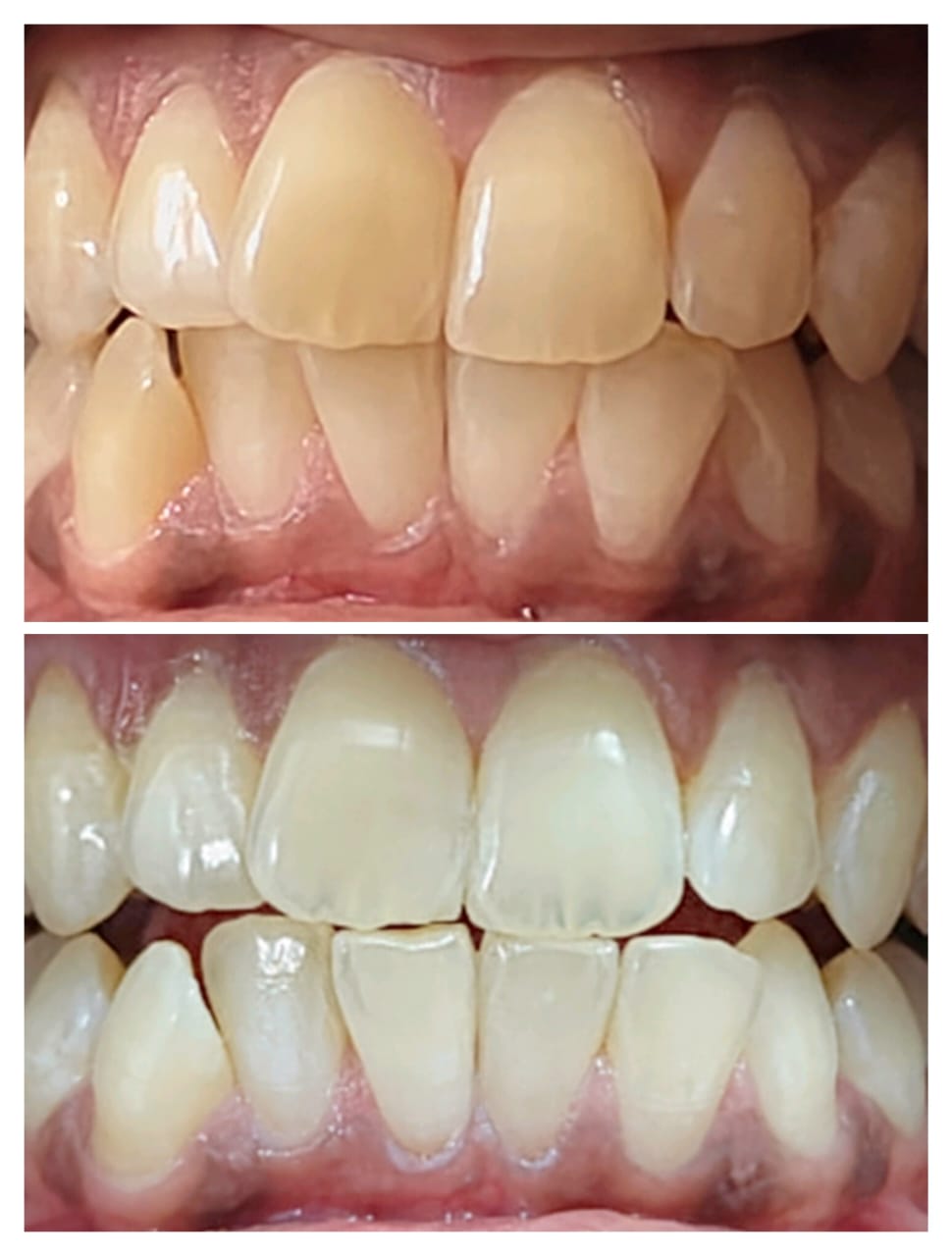 Best Teeth Whitening Clinic in Indiranagar - House of Smiles