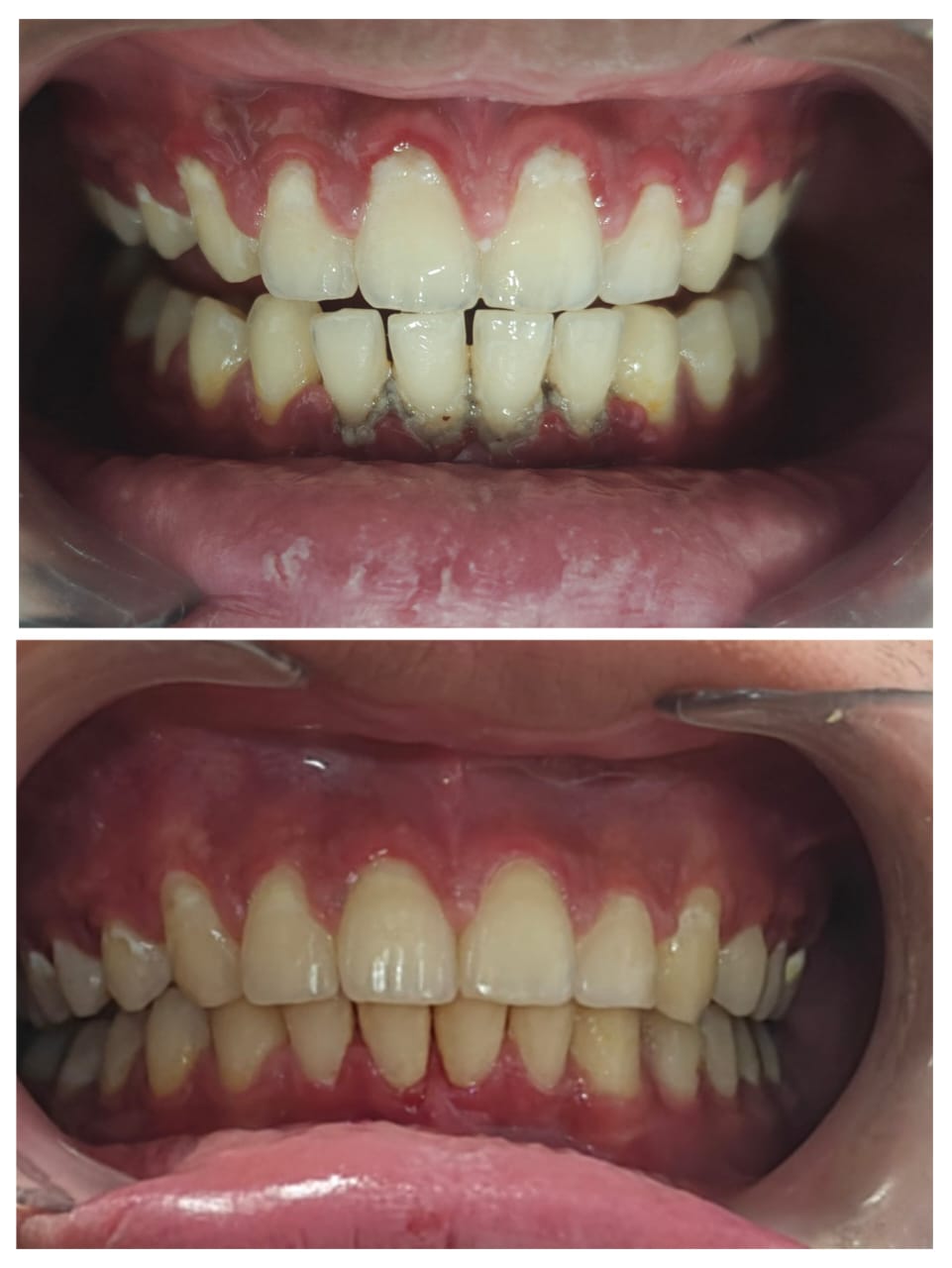 Bleeding Gums Treatment in Indiranagar | Gum Infection Treatment ...